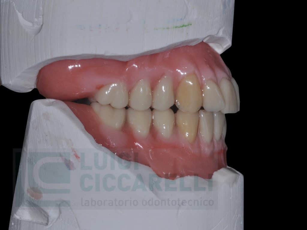 Removable implant-supported prosthesis. Case report - MyZerodonto