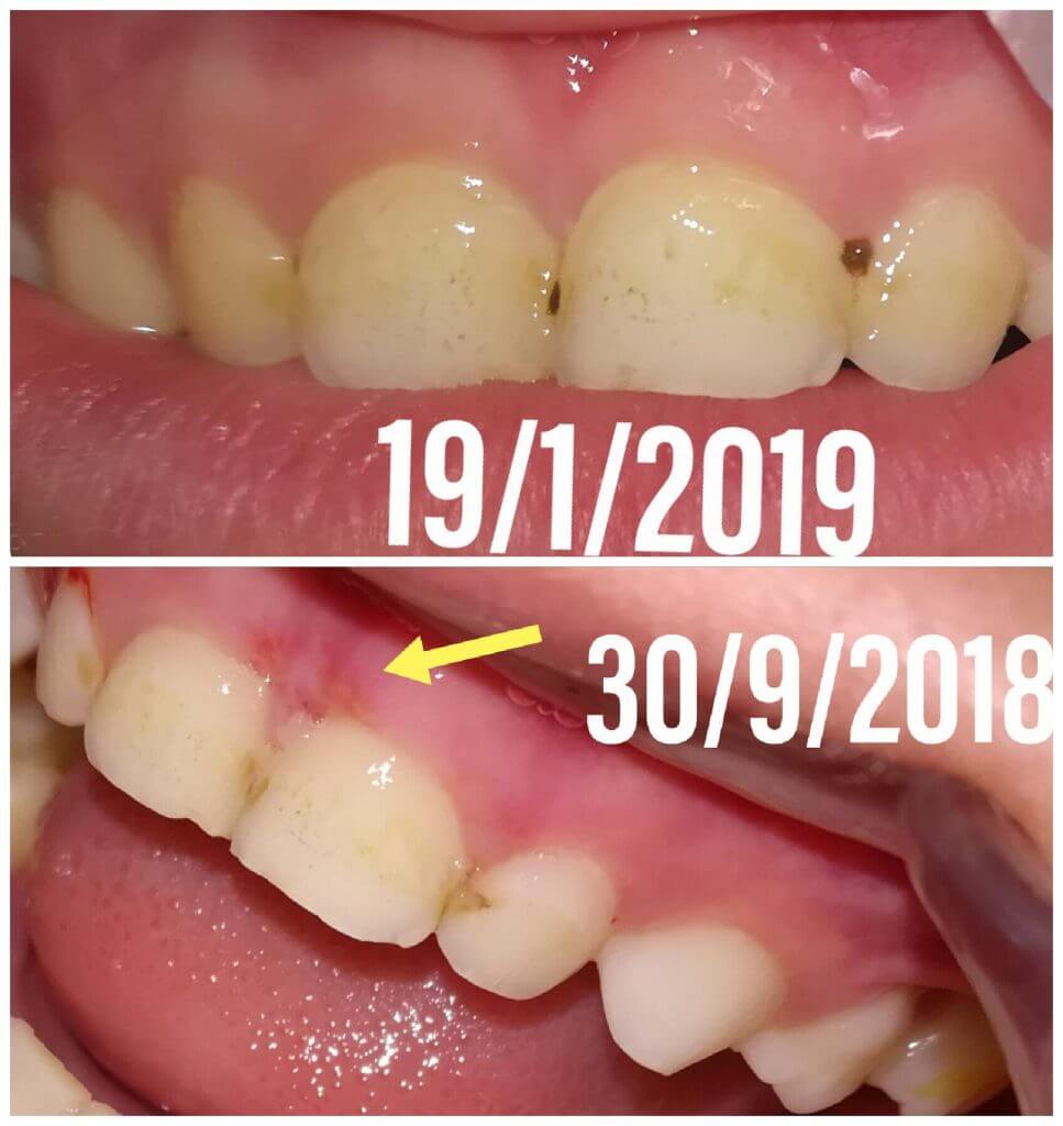 Juvenile Periodontitis for a 4 years child "Child with knife ...