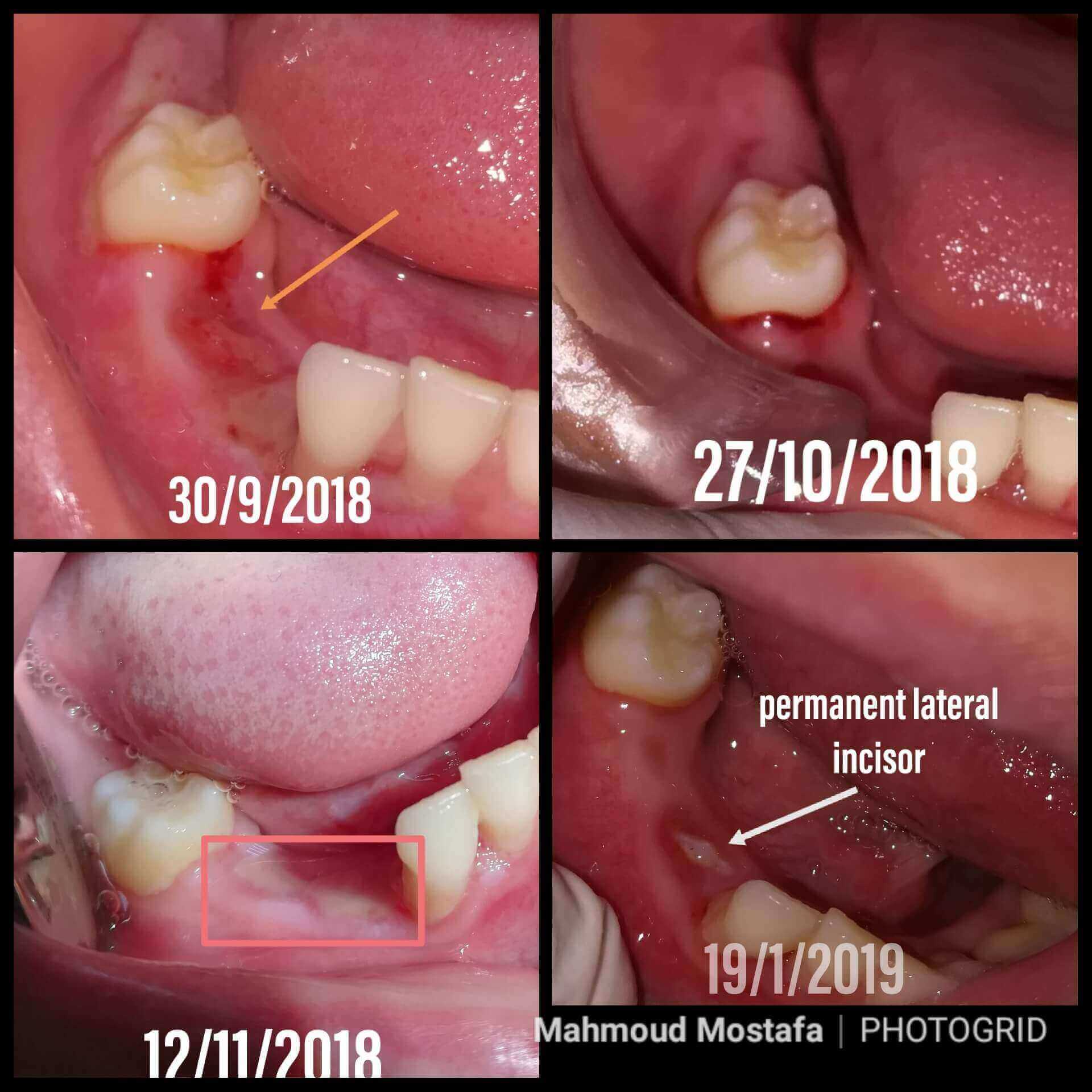 Juvenile Periodontitis for a 4 years child "Child with knife ...