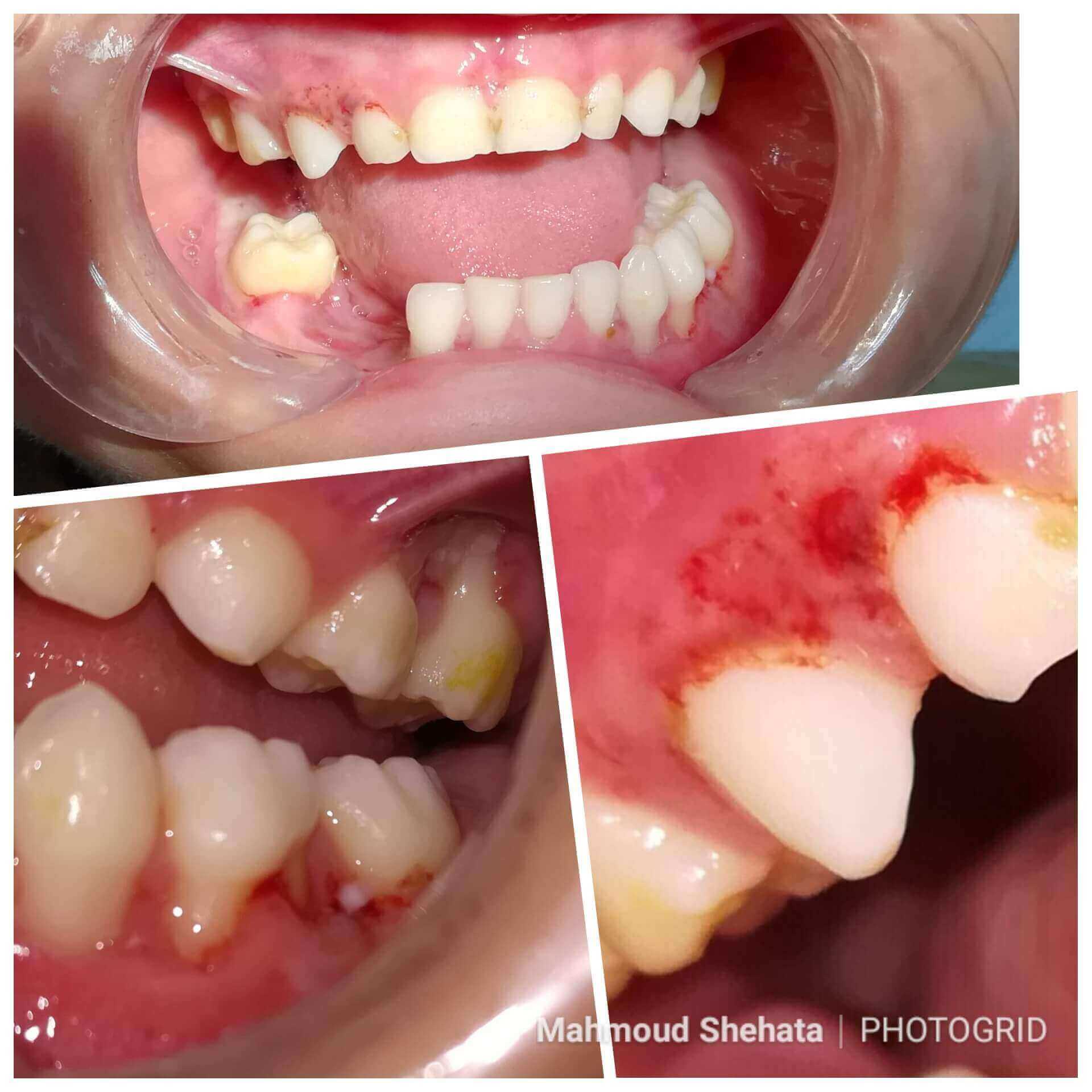 Juvenile Periodontitis for a 4 years child "Child with knife ...