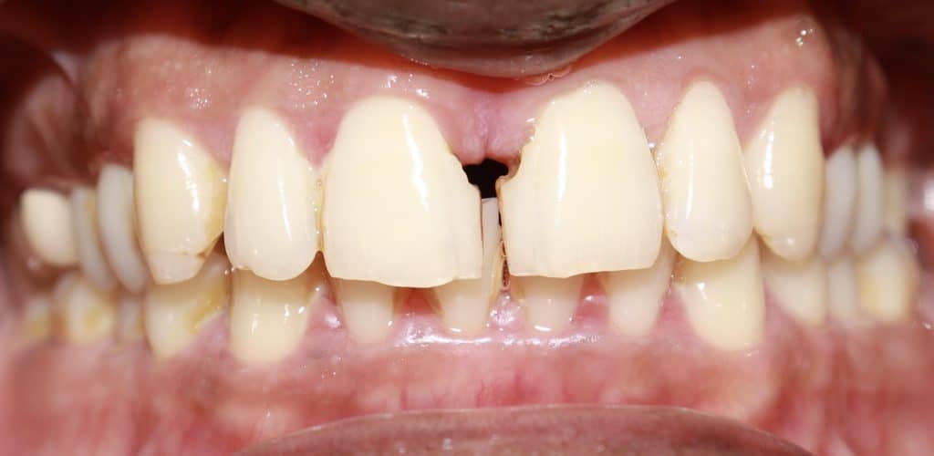 Midline Diastema Closure With Composite After Frenectomy Myzerodonto