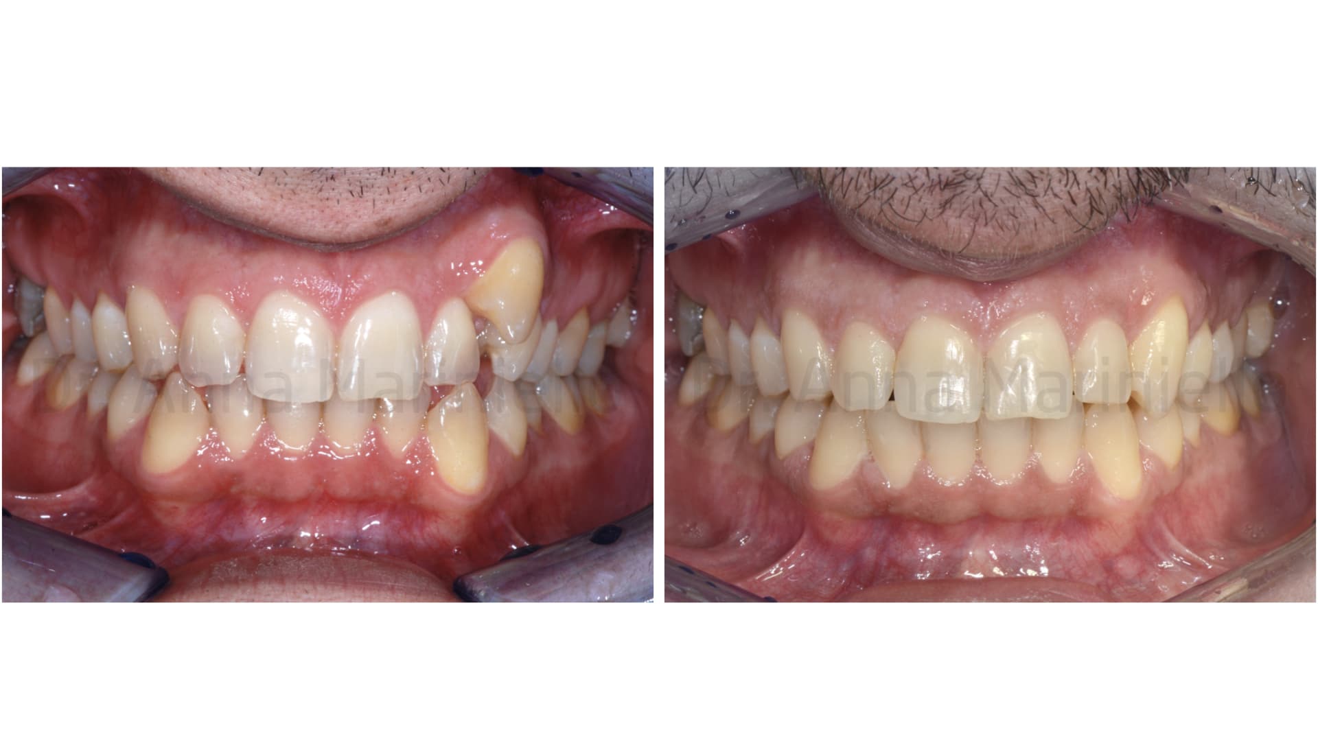 Invisible orthodontics: ectopic buccal canine malocclusion - MyZerodonto