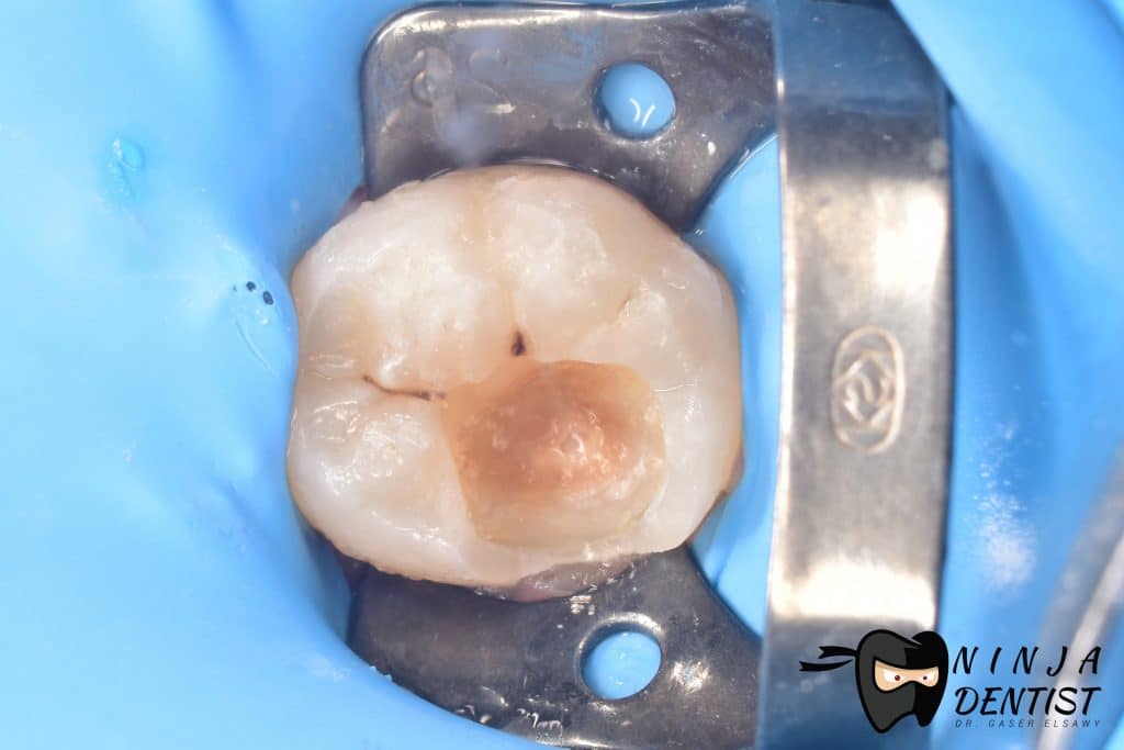 Deep Caries management in young - MyZerodonto