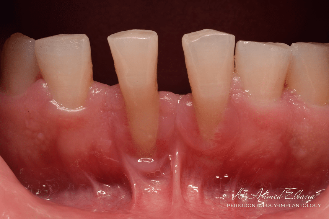Gingival Recession