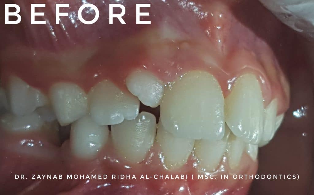 Treatment of Unerupted permanent upper canine due to presence ...