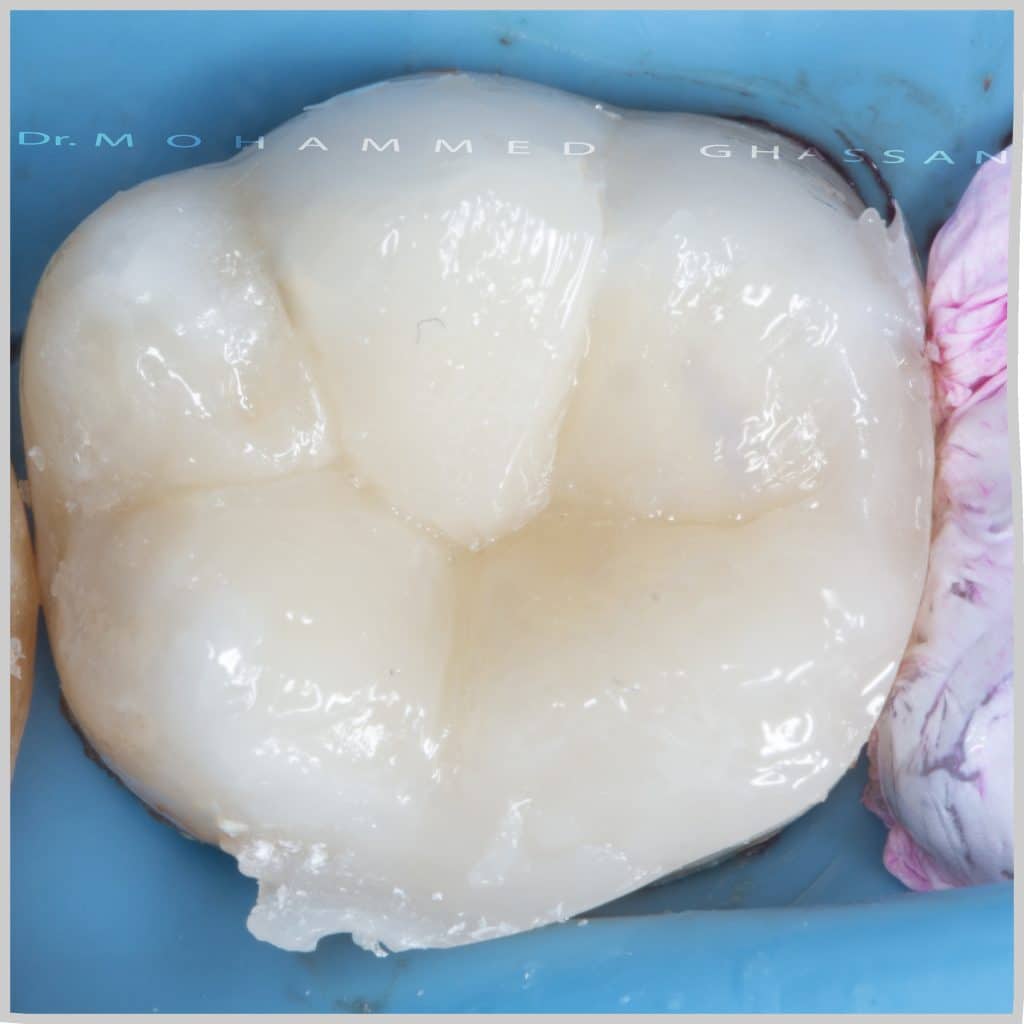 Endodontic treatment with direct composite restoration - MyZerodonto