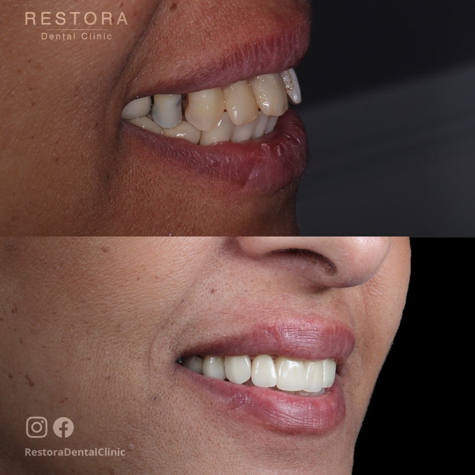 Anterior rehabilitation case - MyZerodonto