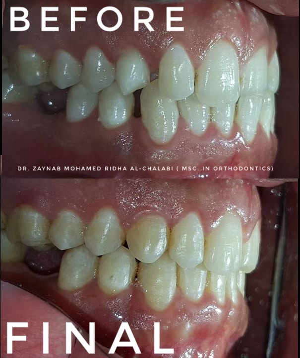 Management of canine transposition - MyZerodonto