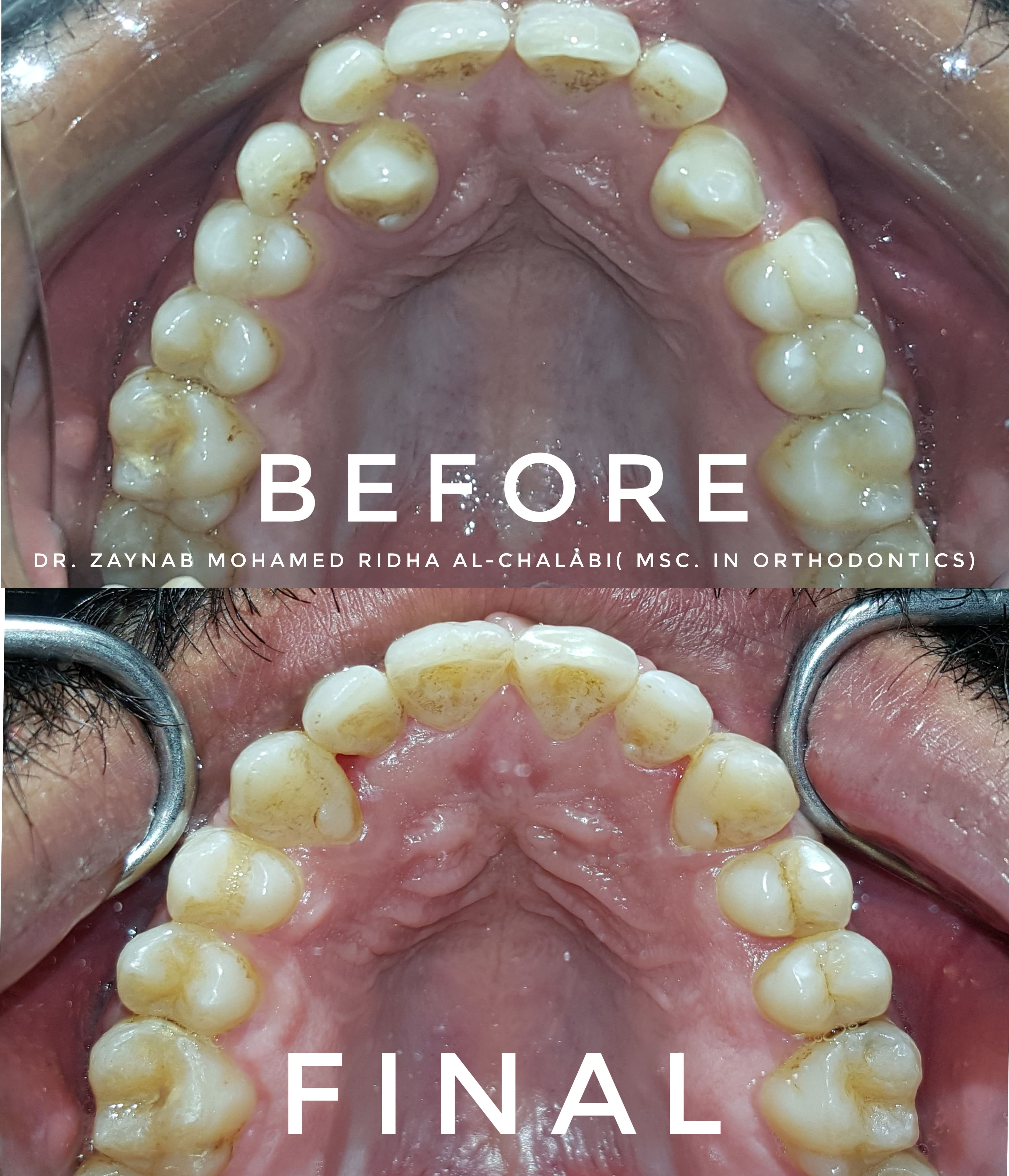 Management of canine transposition - MyZerodonto