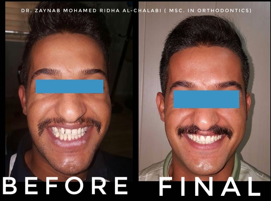 Management of canine transposition - MyZerodonto