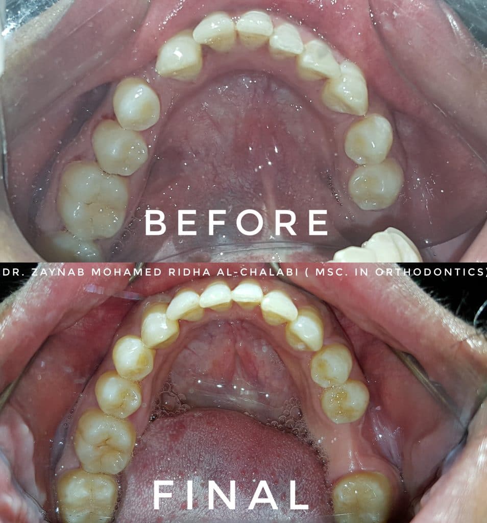 Management of canine transposition - MyZerodonto