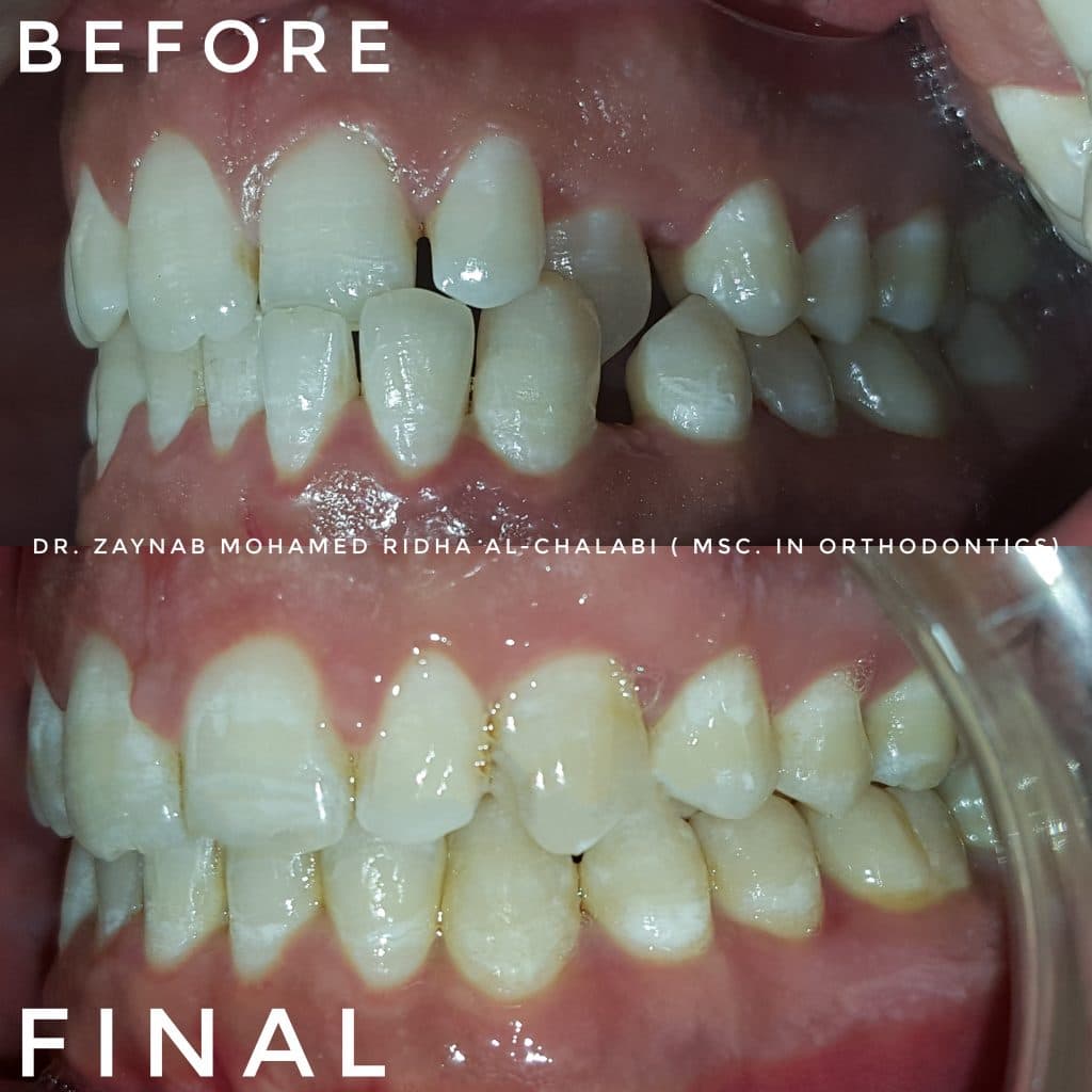 Management of canine transposition - MyZerodonto
