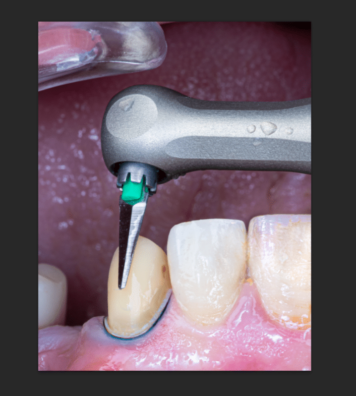 A Smooth and Continuous Preparation Margin is a Key Biomechanical ...