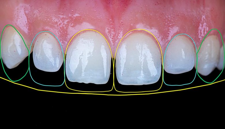 A guided Approach for Aesthetic Re-shaping of Anterior teeth with ...