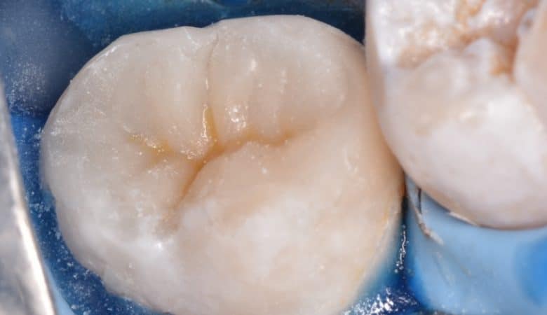 Direct composite onlay - MyZerodonto