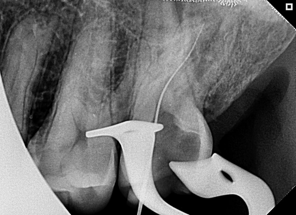 Ledge Bypass - MyZerodonto