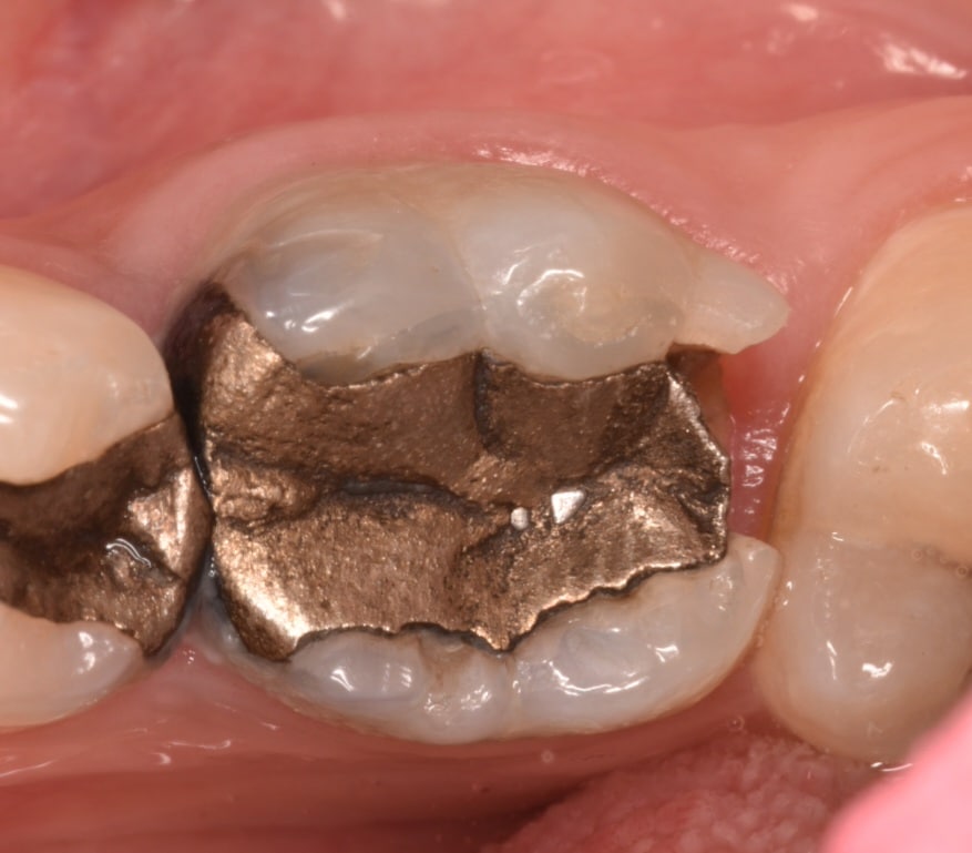 Large amalgam replaced with Indirec lithium disilicate overlay for ...