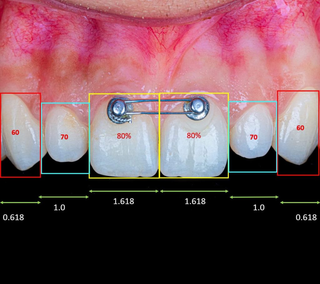Applying the Golden Proportion Concept for the Aesthetic Reshaping of ...