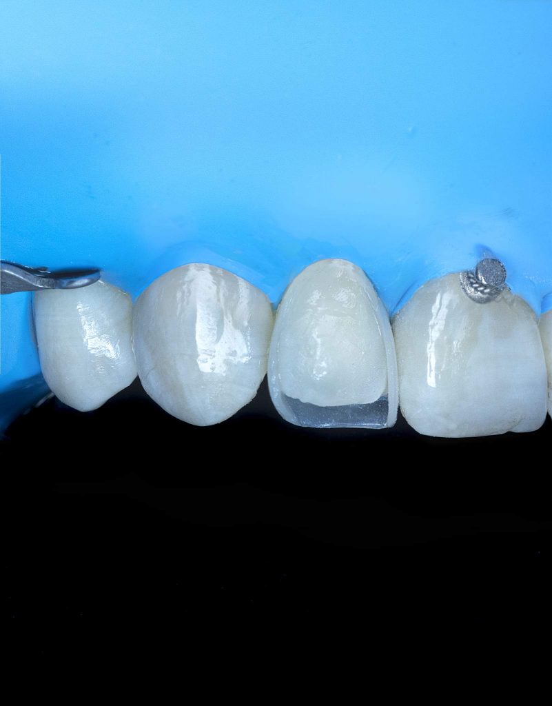 Applying the Golden Proportion Concept for the Aesthetic Reshaping of ...