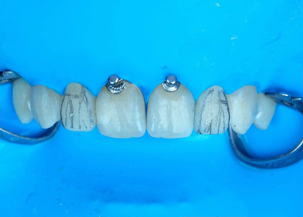 Applying the Golden Proportion Concept for the Aesthetic Reshaping of ...