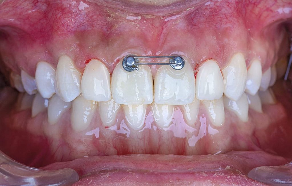 Applying the Golden Proportion Concept for the Aesthetic Reshaping of ...