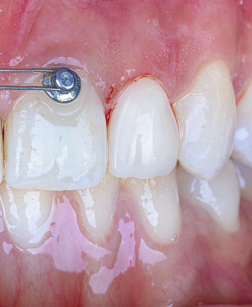 Applying the Golden Proportion Concept for the Aesthetic Reshaping of ...