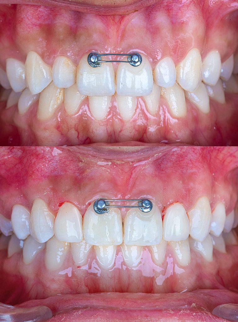 Applying the Golden Proportion Concept for the Aesthetic Reshaping of ...