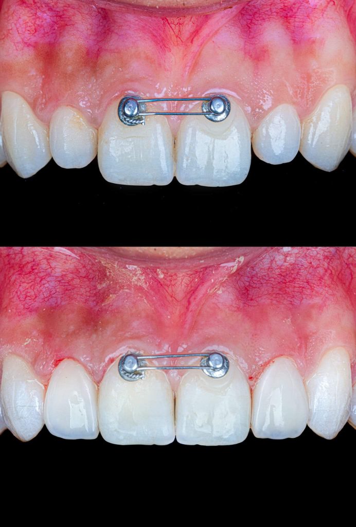 Applying the Golden Proportion Concept for the Aesthetic Reshaping of ...