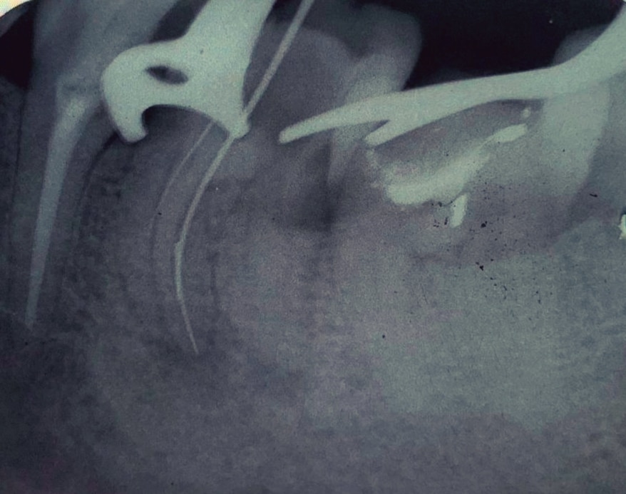 Management of broken file ,ledge and calcified canal for previously ...