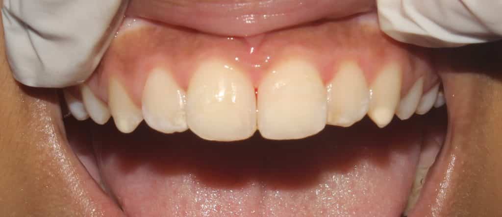 Managing Severe Hypomineralization - MyZerodonto