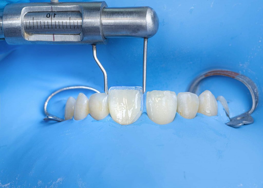 Diastema Closure: A step by step protocol. - MyZerodonto