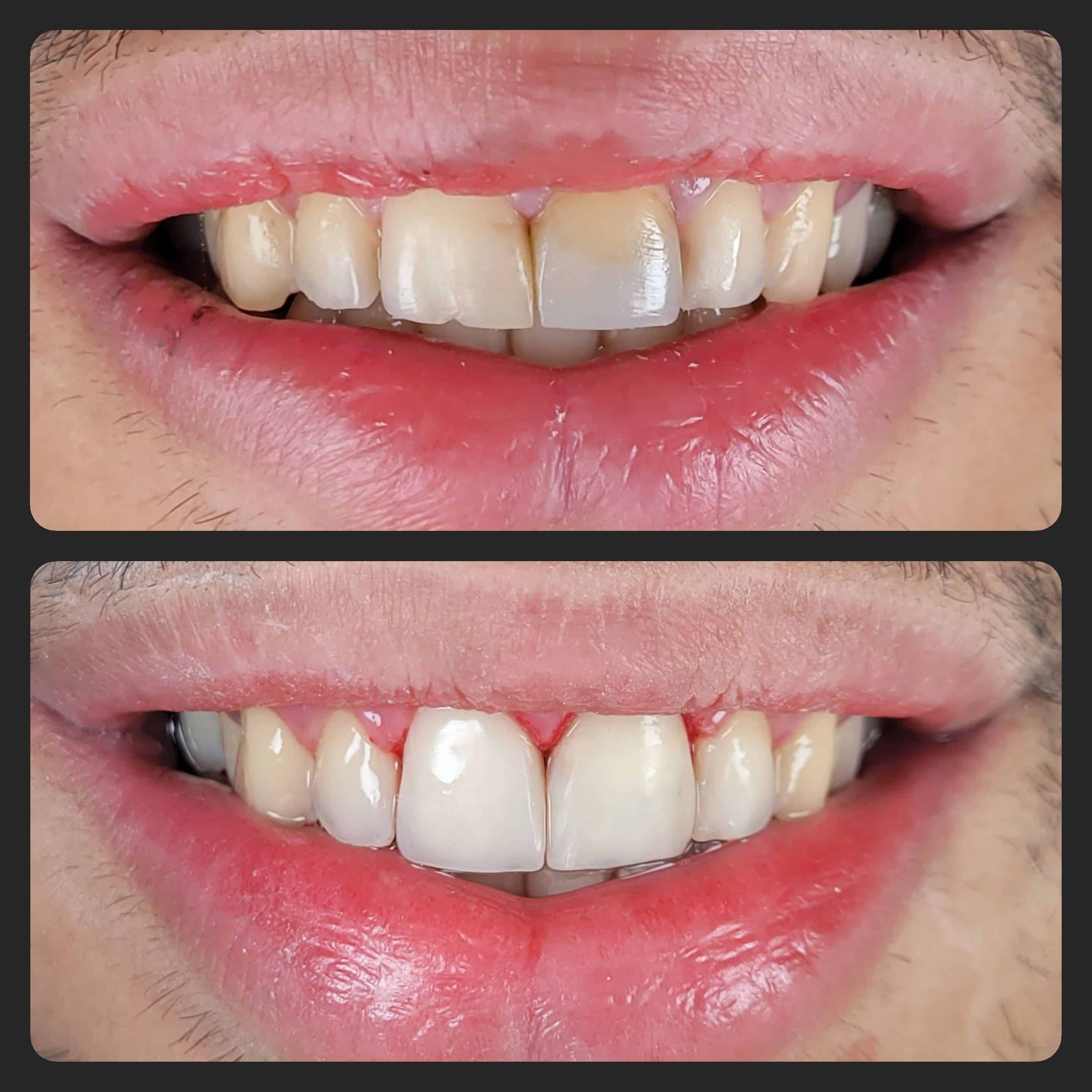 Direct Anterior Composite Restoration Myzerodonto