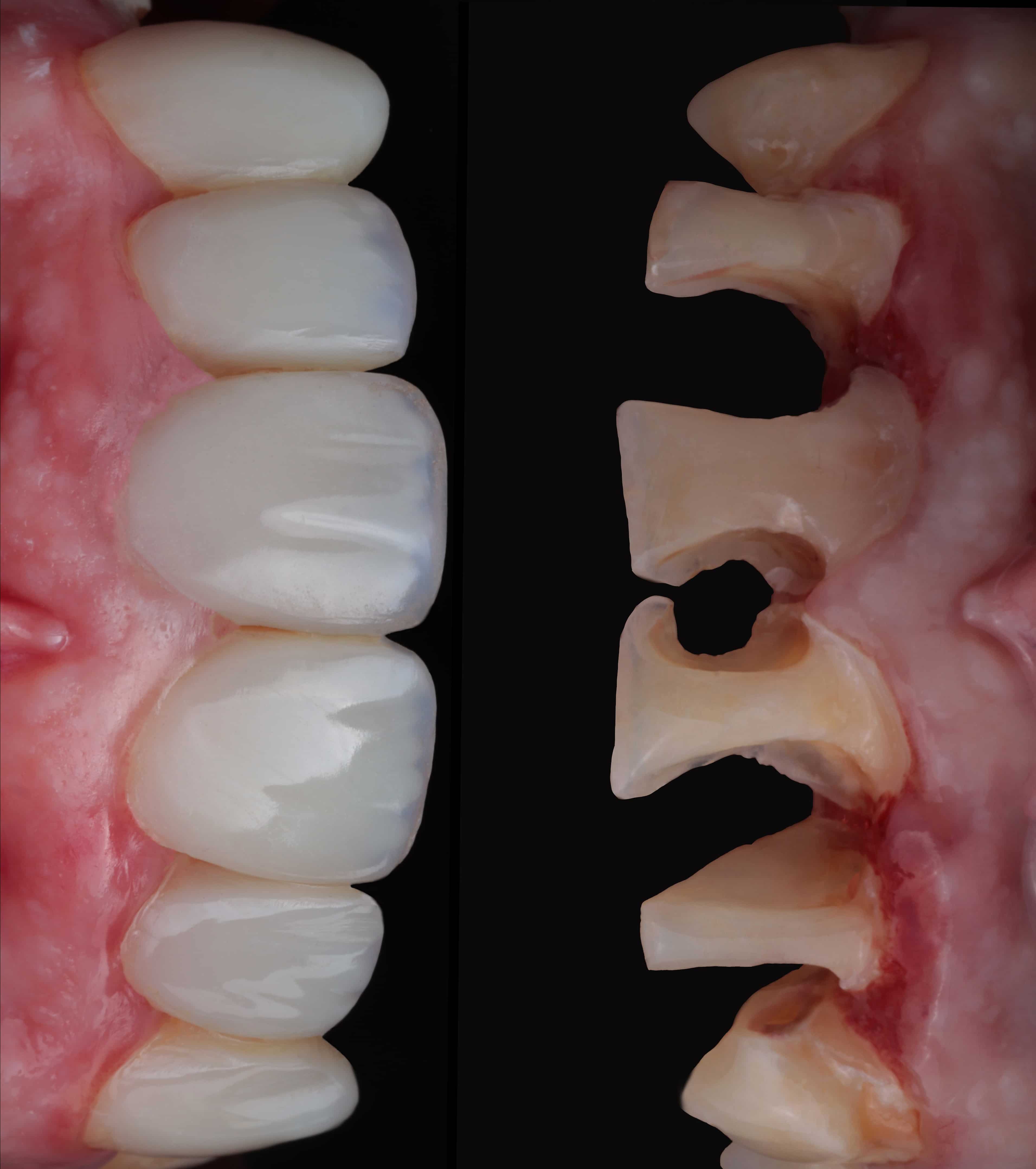 Alter shap,shade,alignment of six anterior badly broken teeth by direct ...