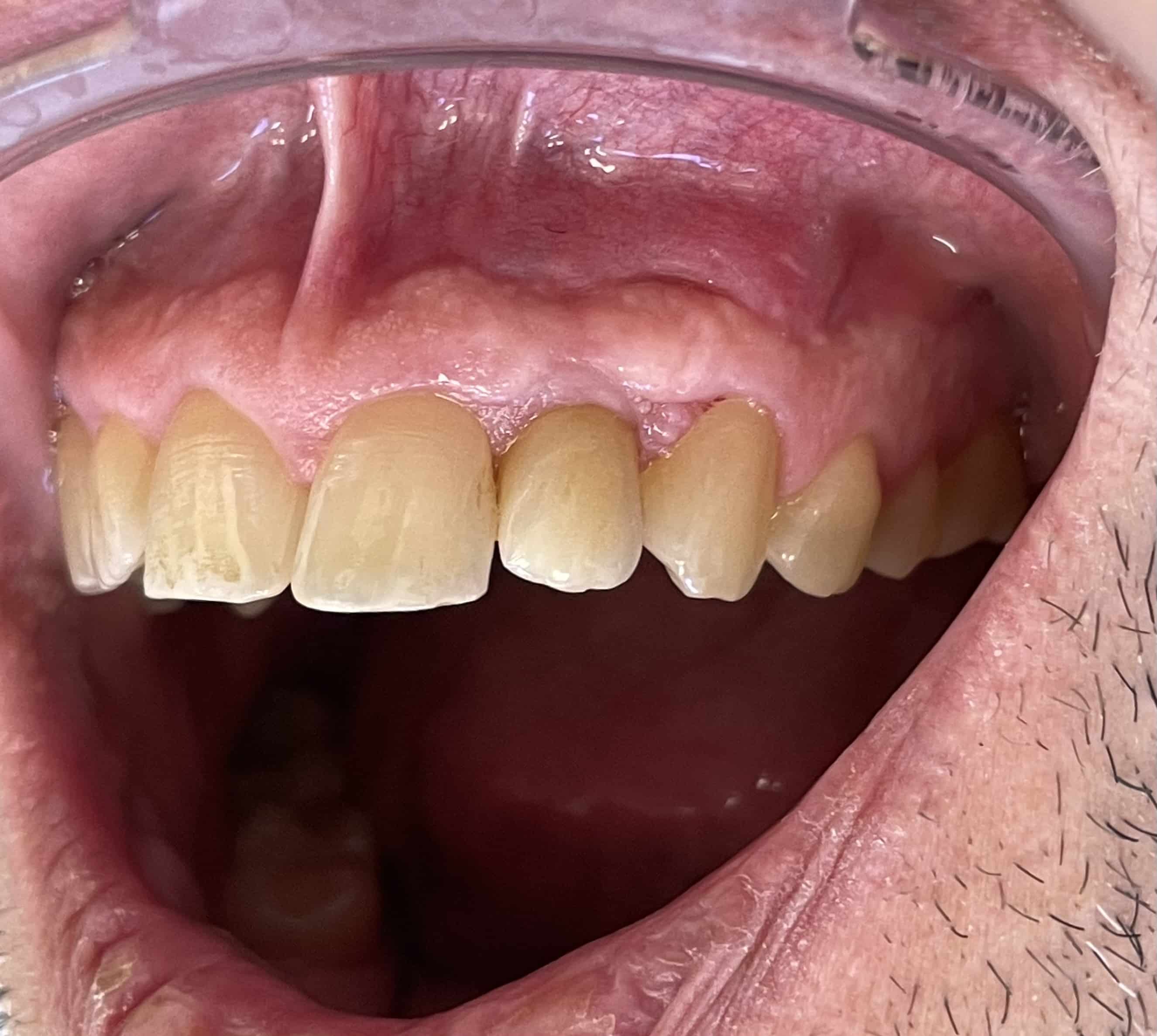 2.2 Implant crown screw retained with bone regeneration (sausage ...