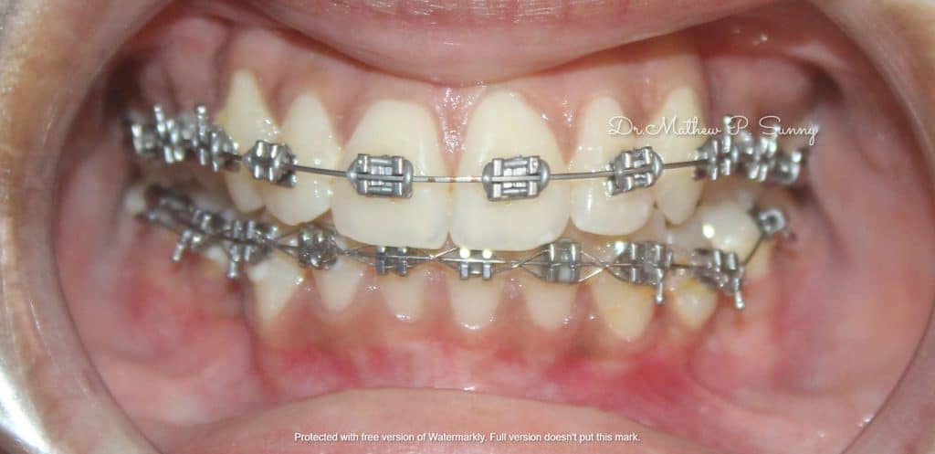 The Beauty of Driftodontics - MyZerodonto