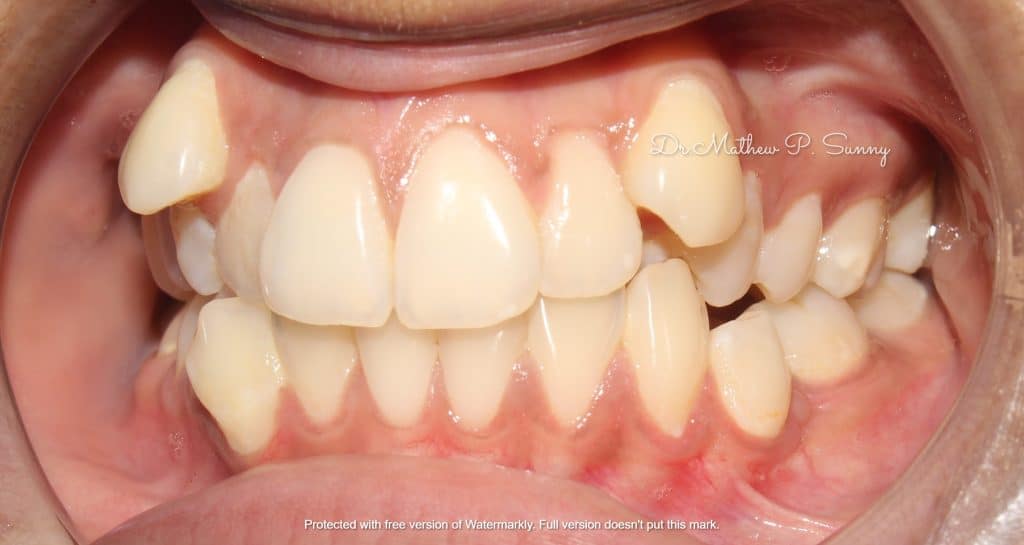 The Beauty of Driftodontics - MyZerodonto