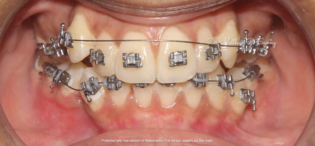 The Beauty of Driftodontics - MyZerodonto