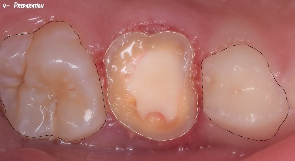 How to Deal with Stainless Steel ? - MyZerodonto