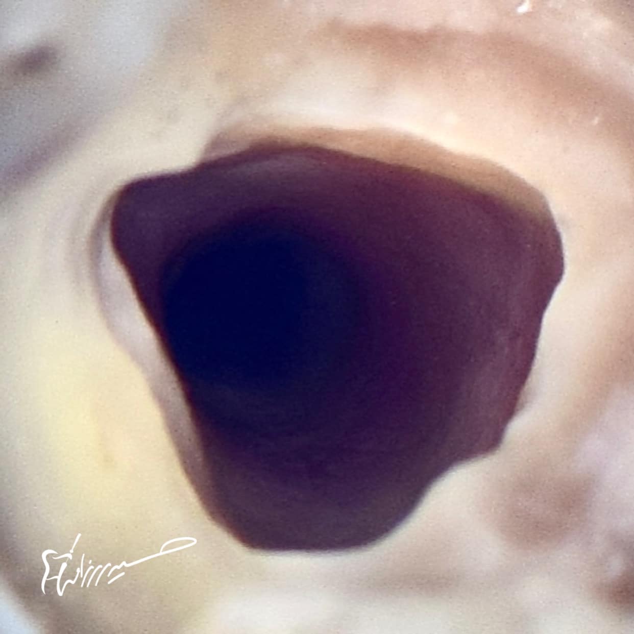Lower second molar with single canal . - MyZerodonto