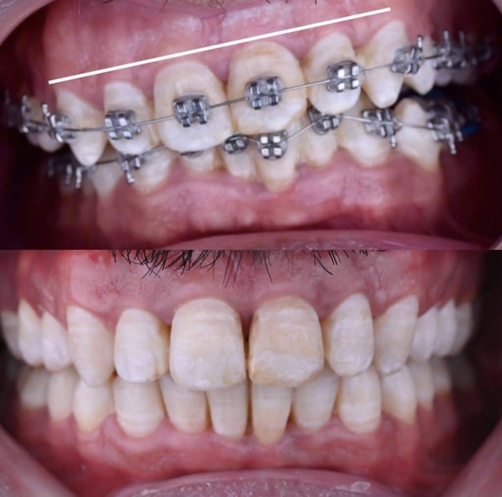 Jaw canting correction without tads only by use of hand made yin yang ...