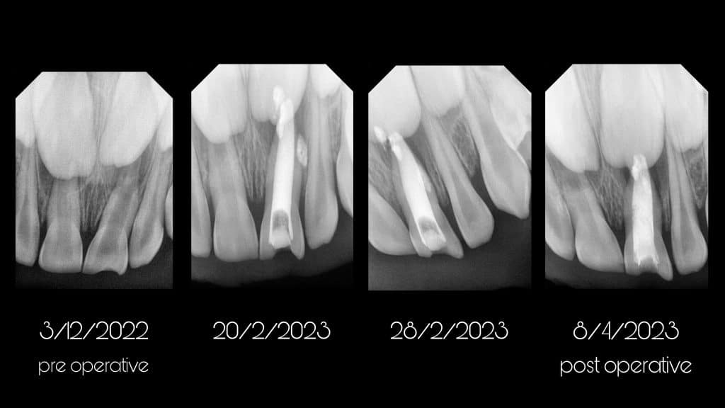 The magic of iodoform - MyZerodonto