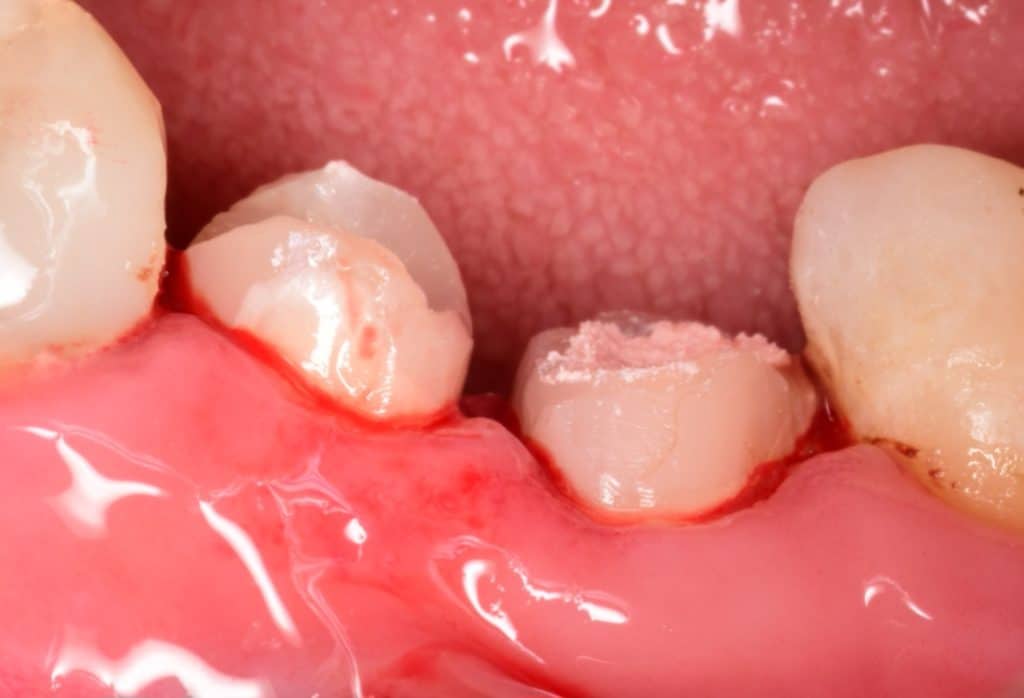 Premolars rehabilitation - MyZerodonto