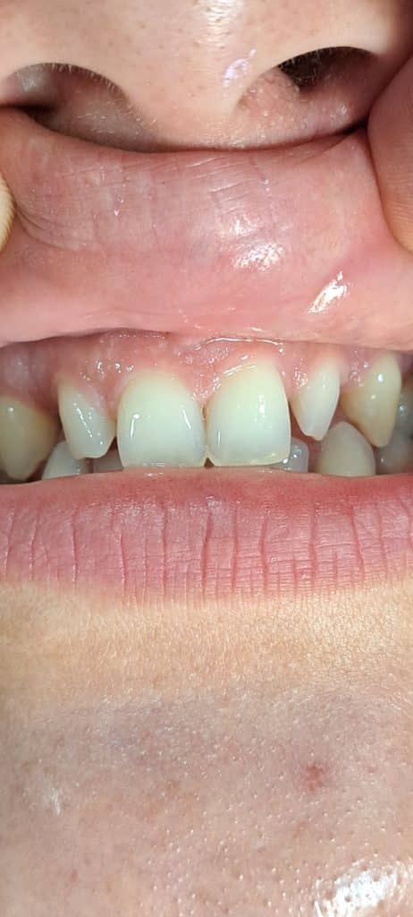 corone estetiche su 1.2 e 2.2 conoidi - MyZerodonto