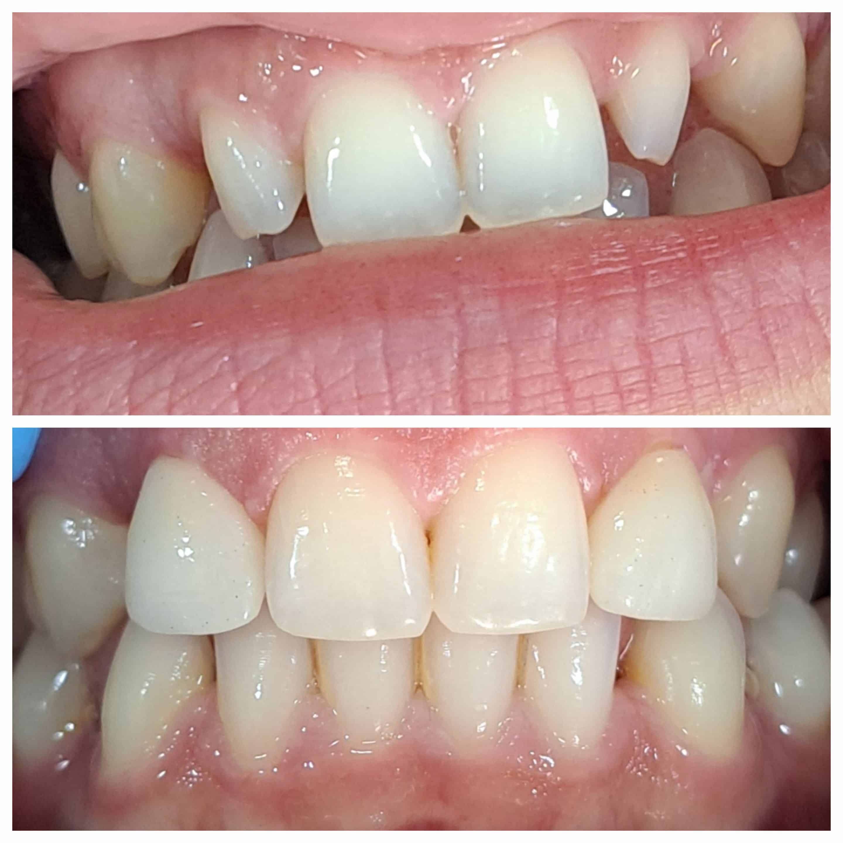 corone estetiche su 1.2 e 2.2 conoidi - MyZerodonto