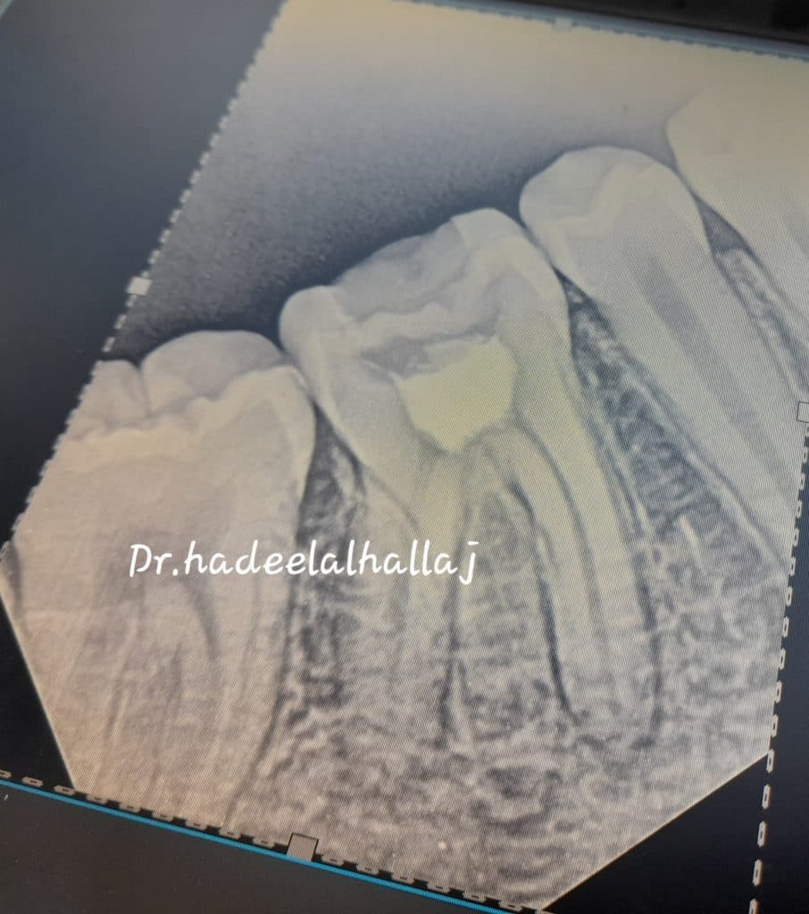 Vital pulp therapy era - MyZerodonto