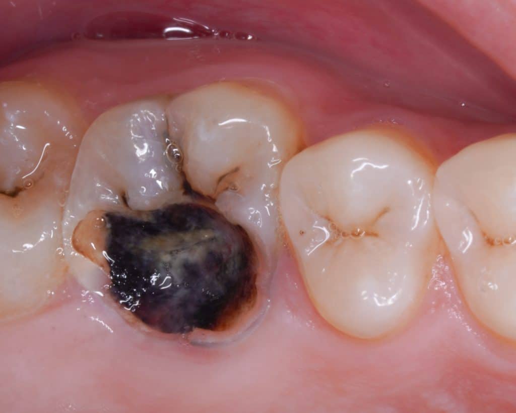 Exo is the last option to think about. - MyZerodonto