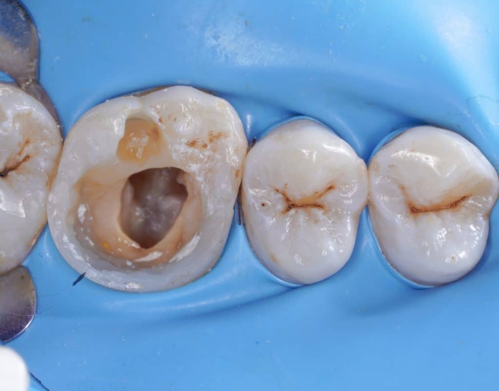 Exo is the last option to think about. - MyZerodonto