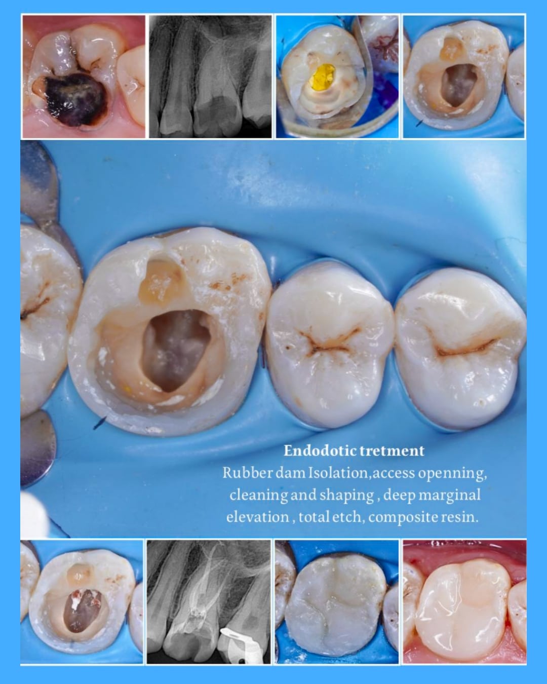 Exo is the last option to think about. - MyZerodonto