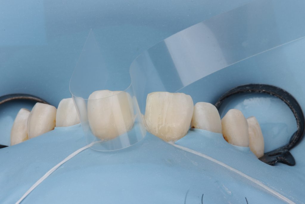 Diastema closure step by step as simple as possible - MyZerodonto