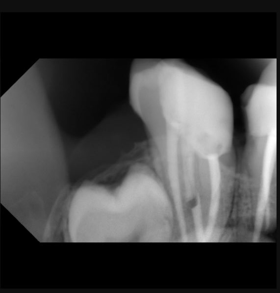 Pre-endo build-up - MyZerodonto